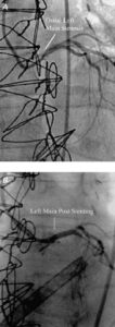 Hemodynamic support with a percutaneous left ventricular assist device ...