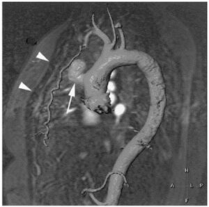 Prosthetic graft remnant-related pseudoaneurysm after left ventricular ...